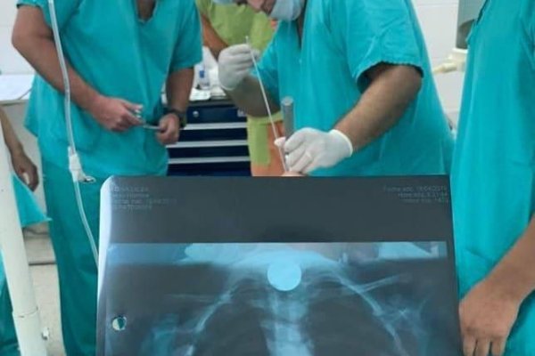 Extraen una moneda del esófago en innovadora operación en Cepsi | Nuevo ...