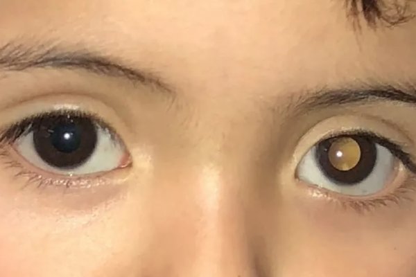 La enfermedad poco conocida que puede causar ceguera en un ojo: los ...